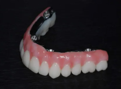 Dental Implant Options and Pricing - Acevedo Dental Group