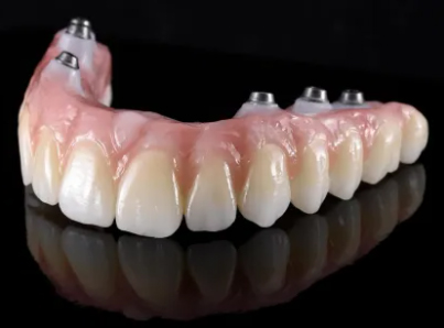 Dental Implant Options and Pricing - Acevedo Dental Group