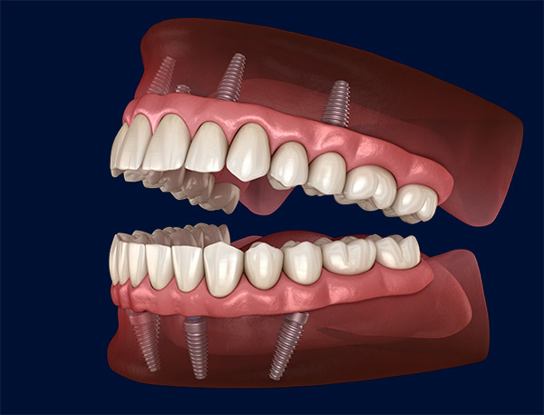 Dental Implant Options and Pricing - Acevedo Dental Group